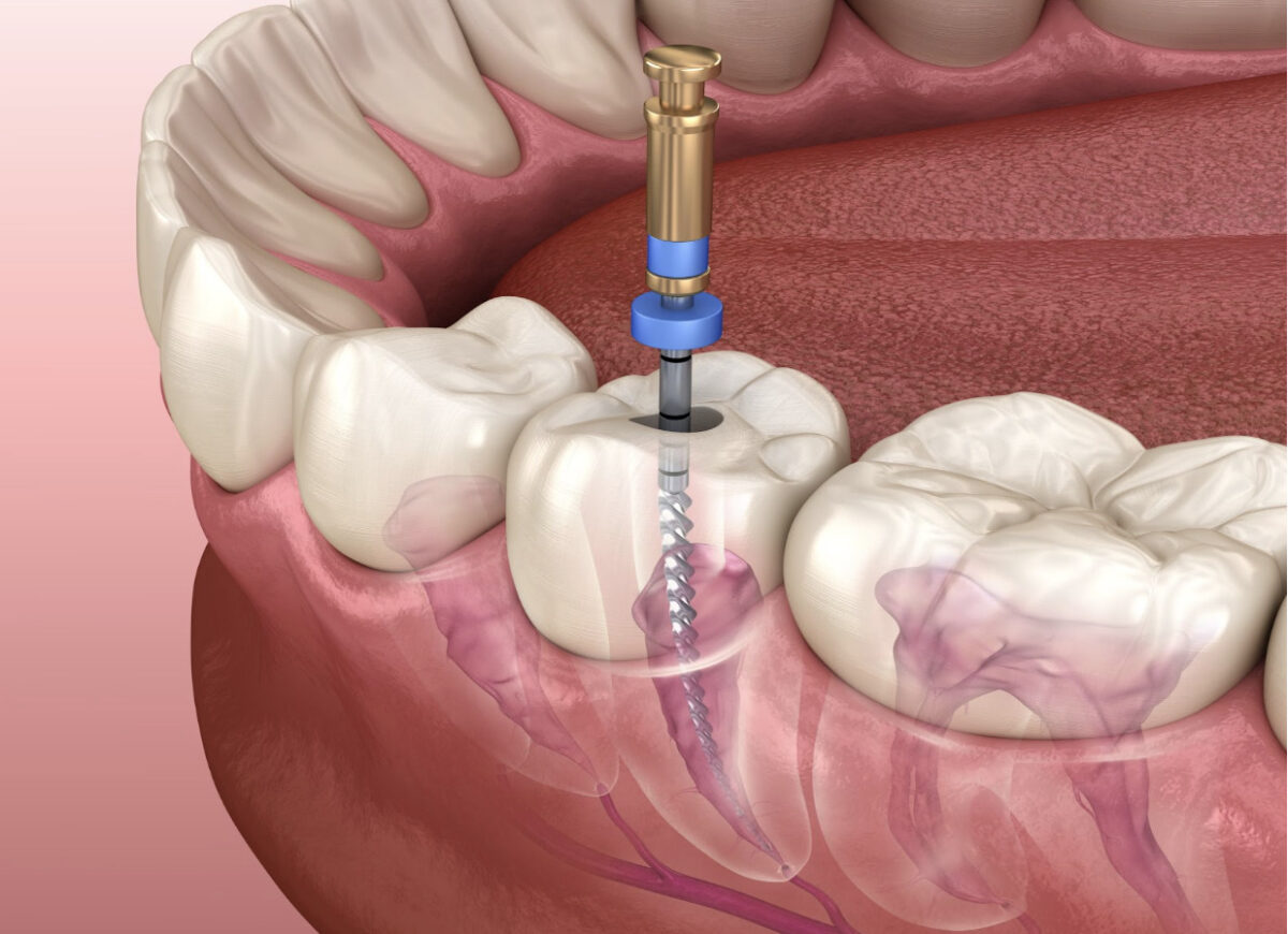 The Root Canal Treatment: How To Save Your Smile